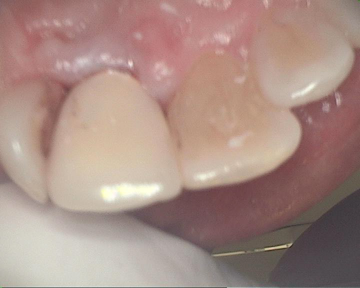 Dental Case Study: Front Tooth Broken To Gum Line; Restore With Crown