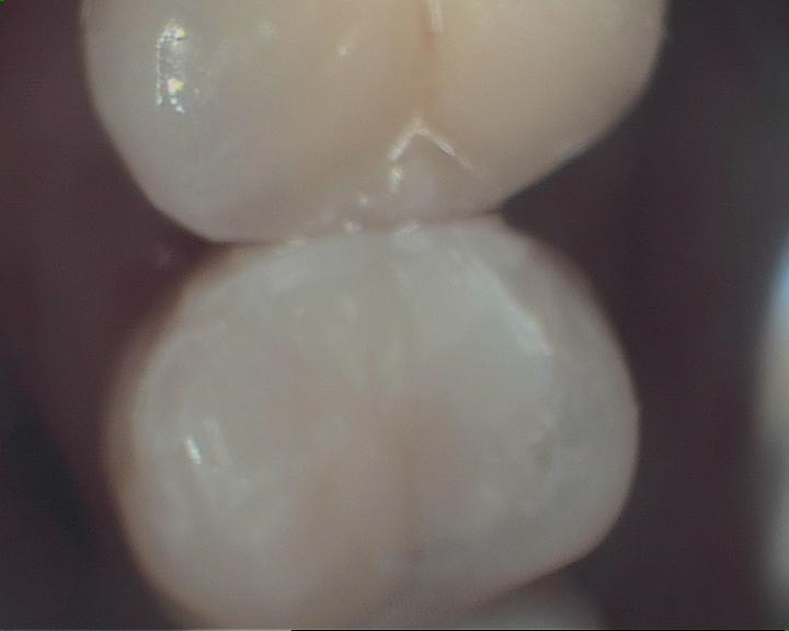 Dental Case Study: Fillings to Close Food Traps