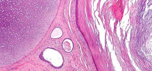 Teratomas: The Tumors with Teeth